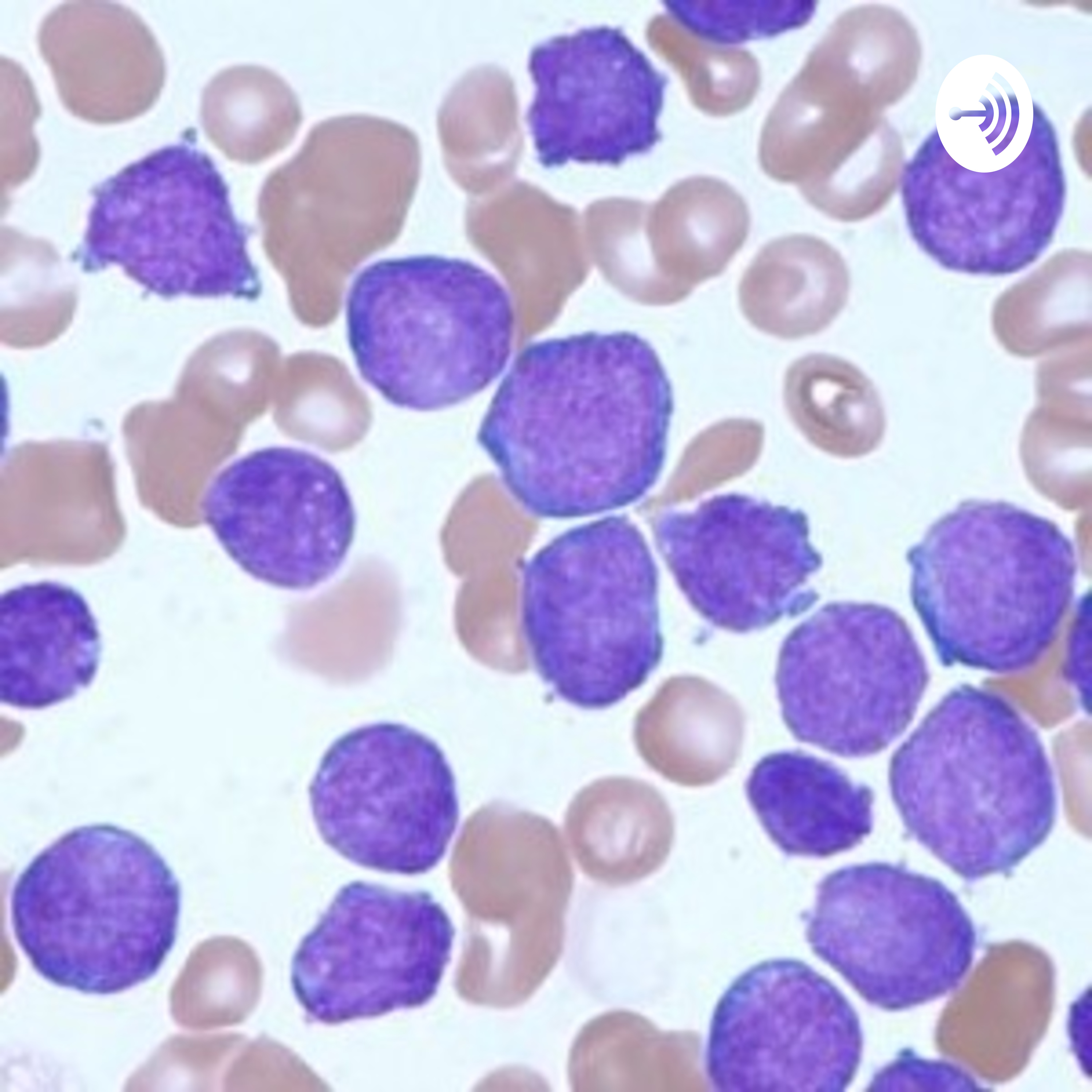 LEUCEMIA LINFOBLASTICA AGUDA - Health Podcast | Podchaser
