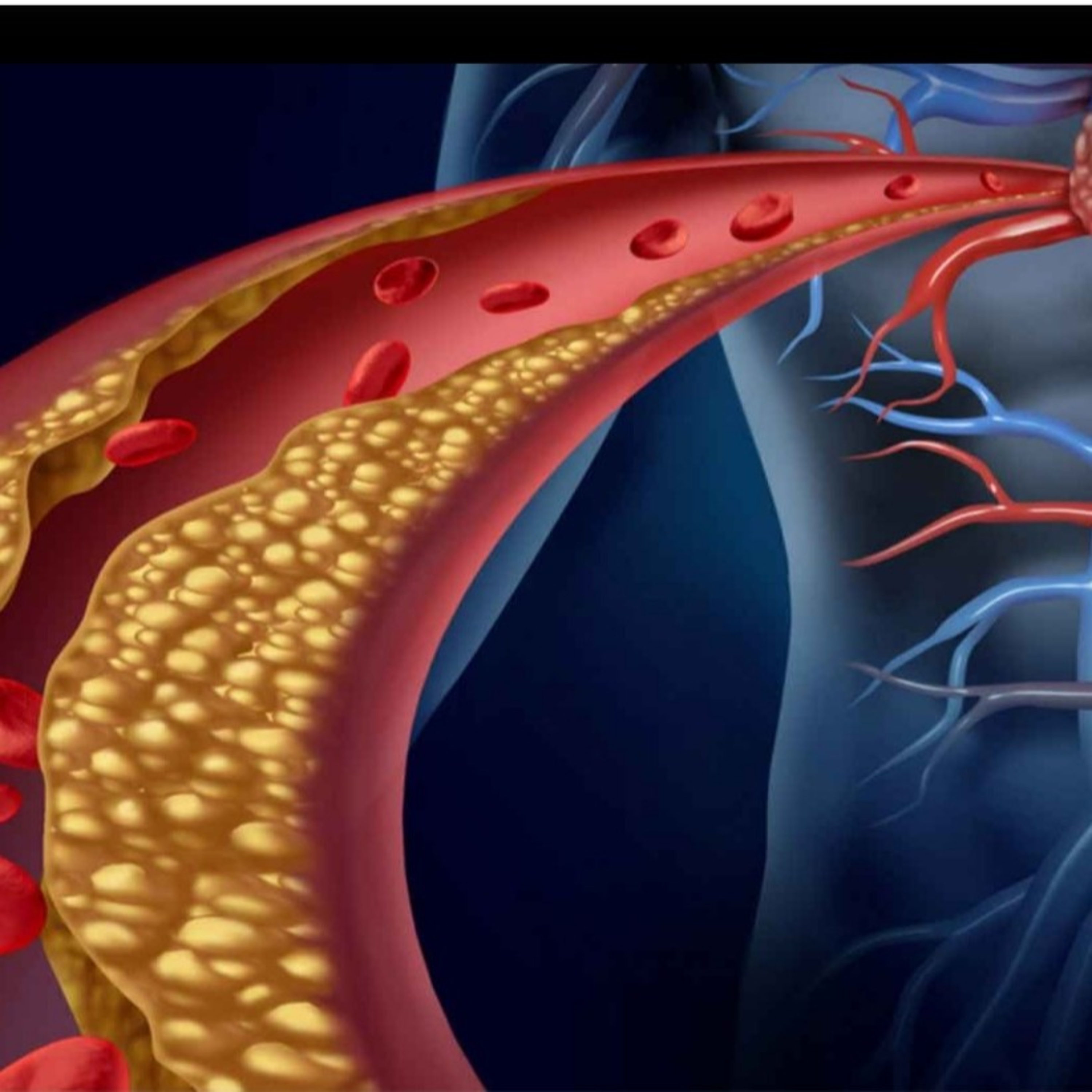 Conociendo la Dislipidemia. – Conociendo La Dislipidemia – Podcast ...