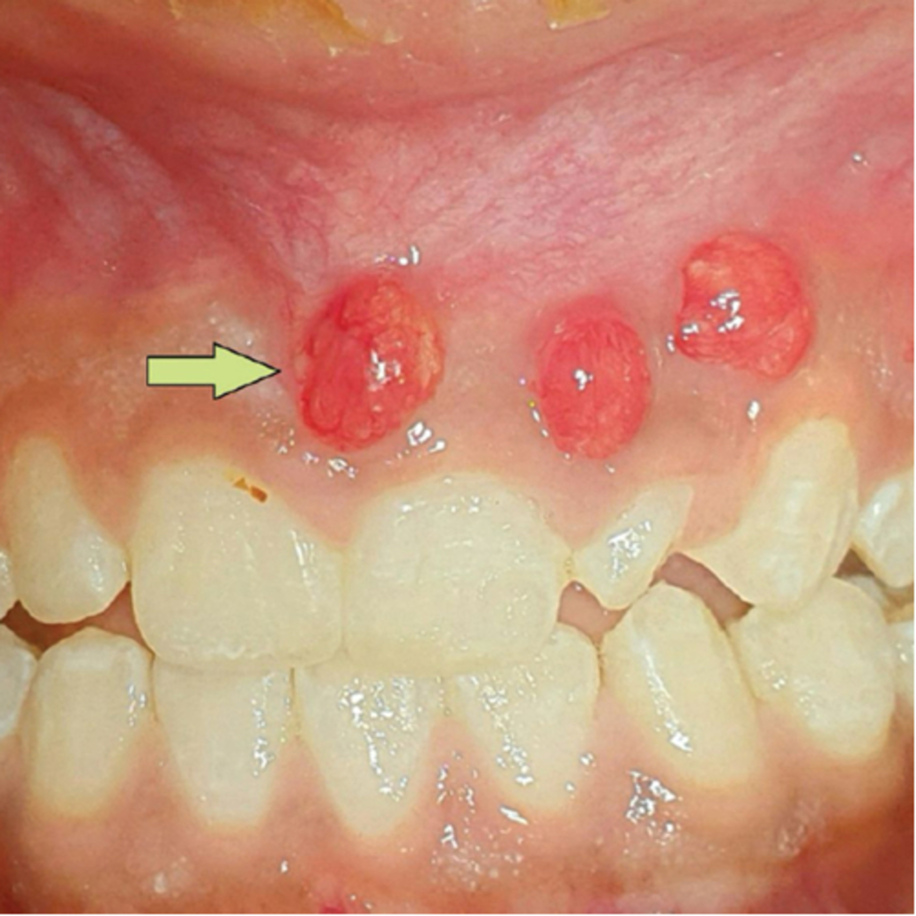 “What are Key Oral & Facial Manifestations of Mucormycosis?” - Dr ...