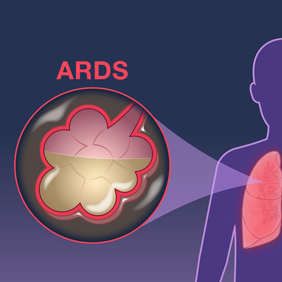 ARDS in Pregnancy (SMFM Review) by Dr. Chapa’s Clinical Pearls.
