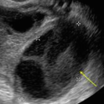Tubo-Ovarian Abscess by Dr. Chapa’s Clinical Pearls.
