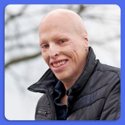 Voor 67% VERBRAND bij de brand in VOLENDAM by HELD IN EIGEN VERHAAL