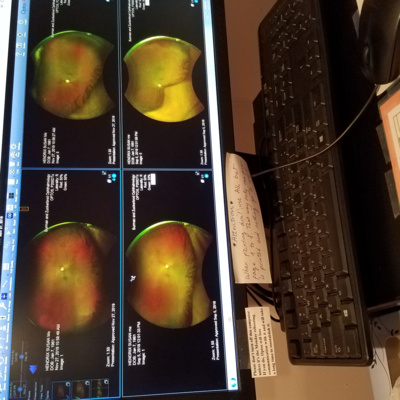 Treatment Toxicity, Age Linked to Eye Complications in SLE by Susan ...