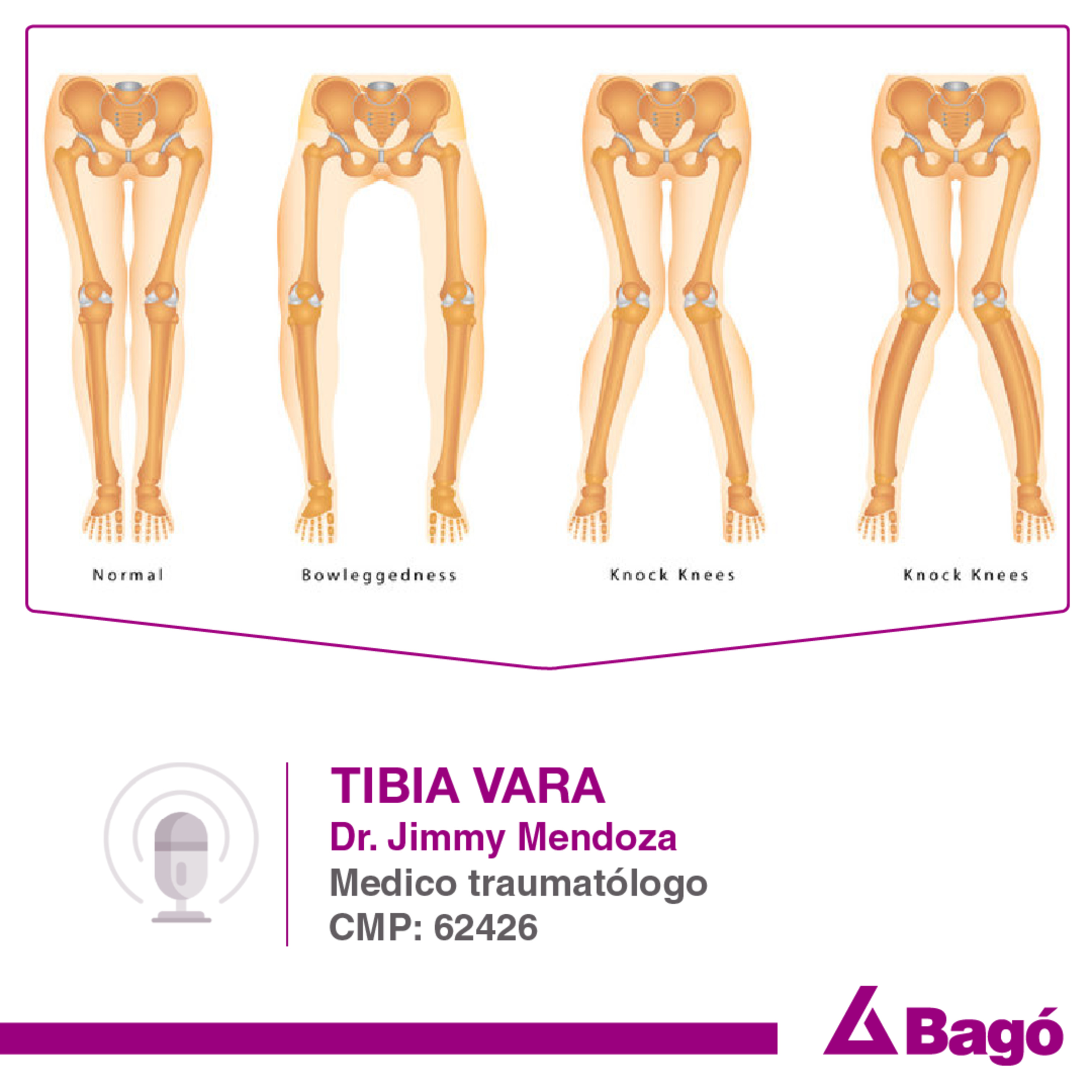 La Tibia Vara: Causas, Síntomas y Tratamiento – Laboratorios Bagó del ...