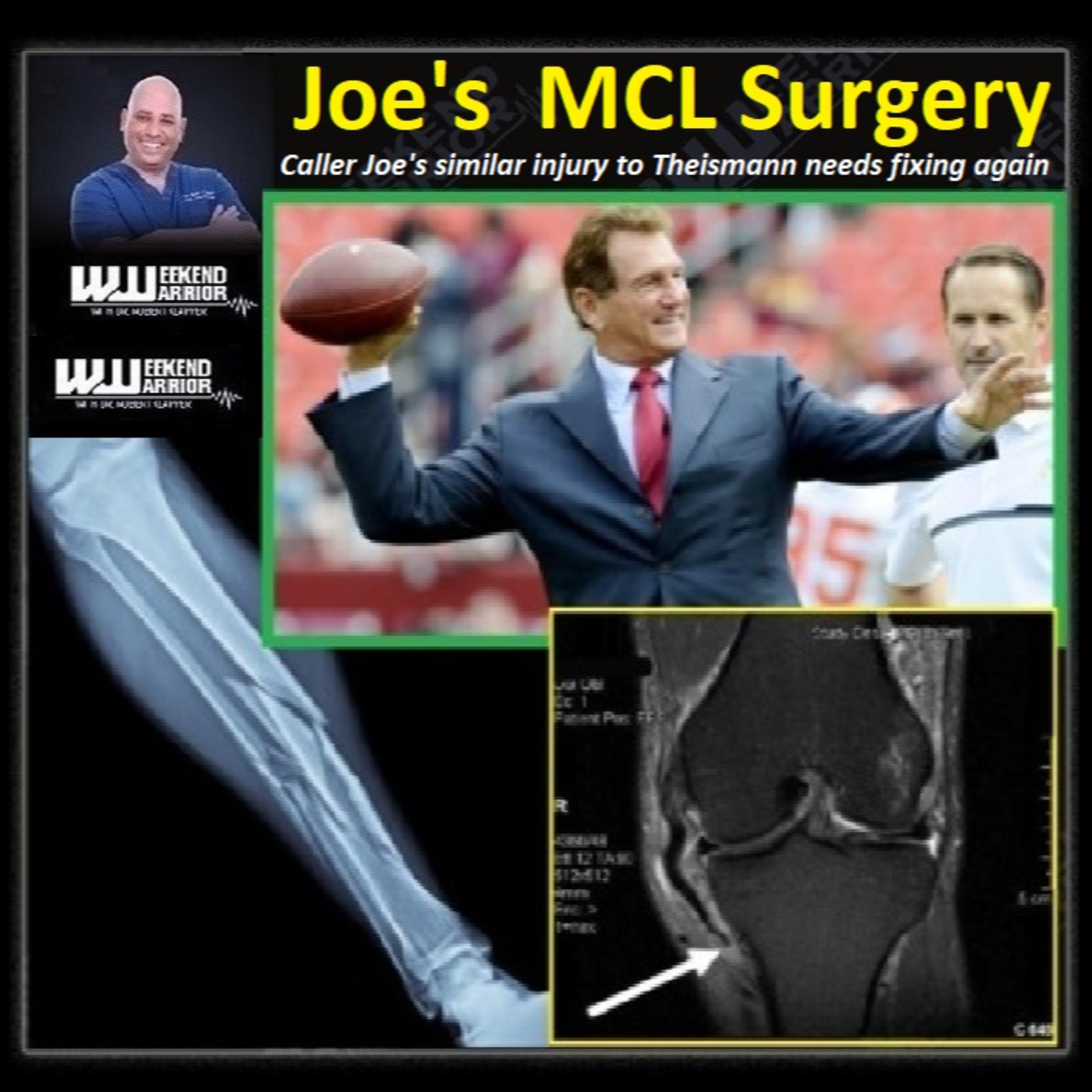 Caller Joe's Botched MCL Surgery – Weekend Warrior with Dr. Robert ...