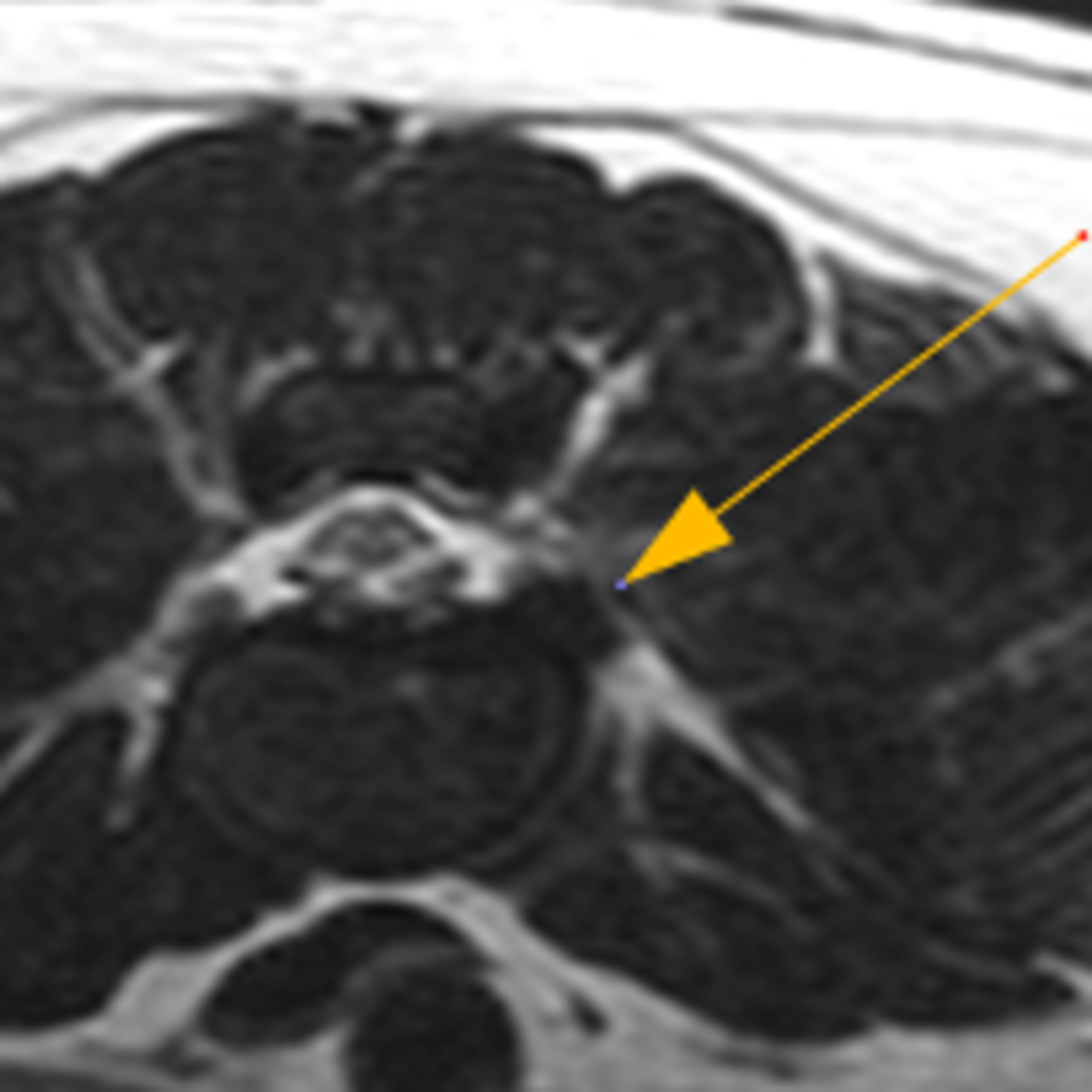 Foraminal and Far Lateral Disc Herniation in Dogs - Web-Vet Neurology ...